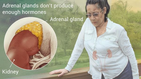 Addison's disease - Symptoms, Cause, Diagnosis & Treatment | Reckon Talk